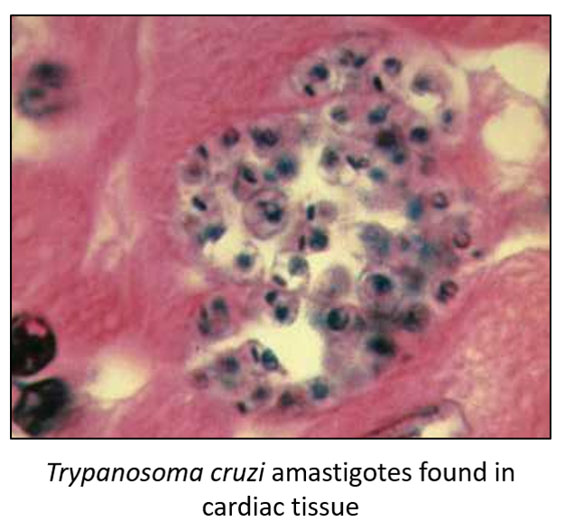 Chagas Disease – SECVBD